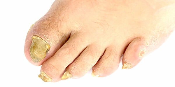 Footcare Conditions Question & Answers